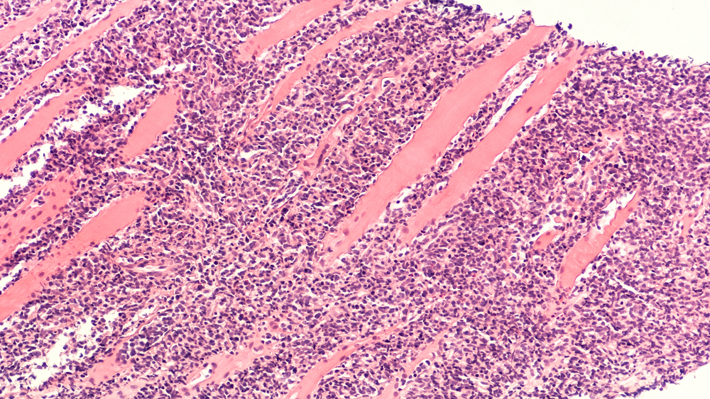 Genetic Drivers of Most Common Form of Lymphoma Found - Research ...