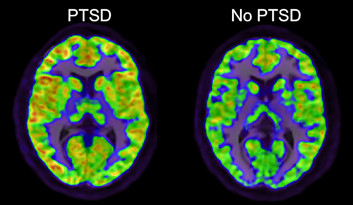 Study Finds Potential New Path for PTSD Treatment - Research ...