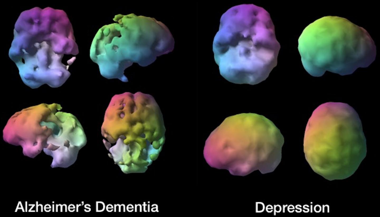 Is it Depression or Dementia? Brain SPECT Imaging Helps Distinguish ...