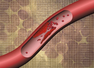 Finding blood clots before they wreak havoc - Research & Development World