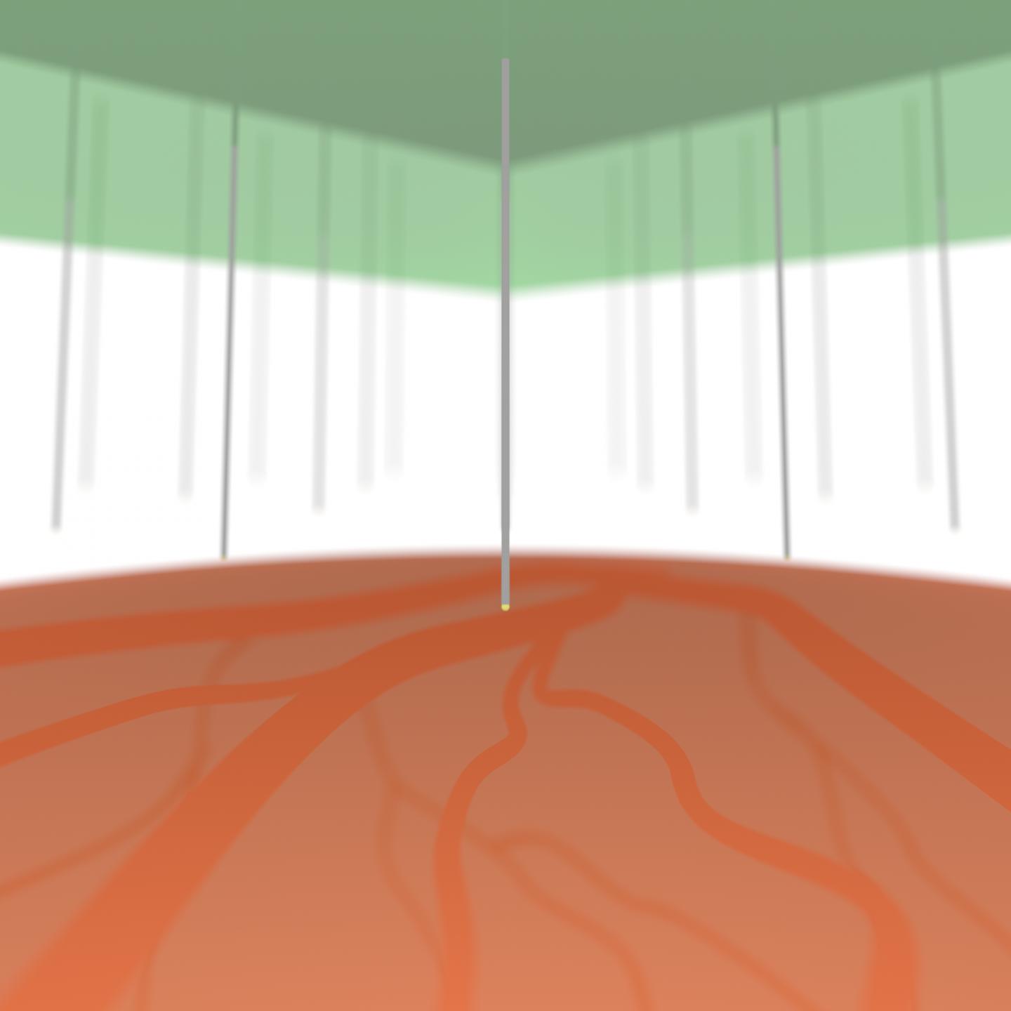 Super-small Needle Technology For the Brain - Research & Development World